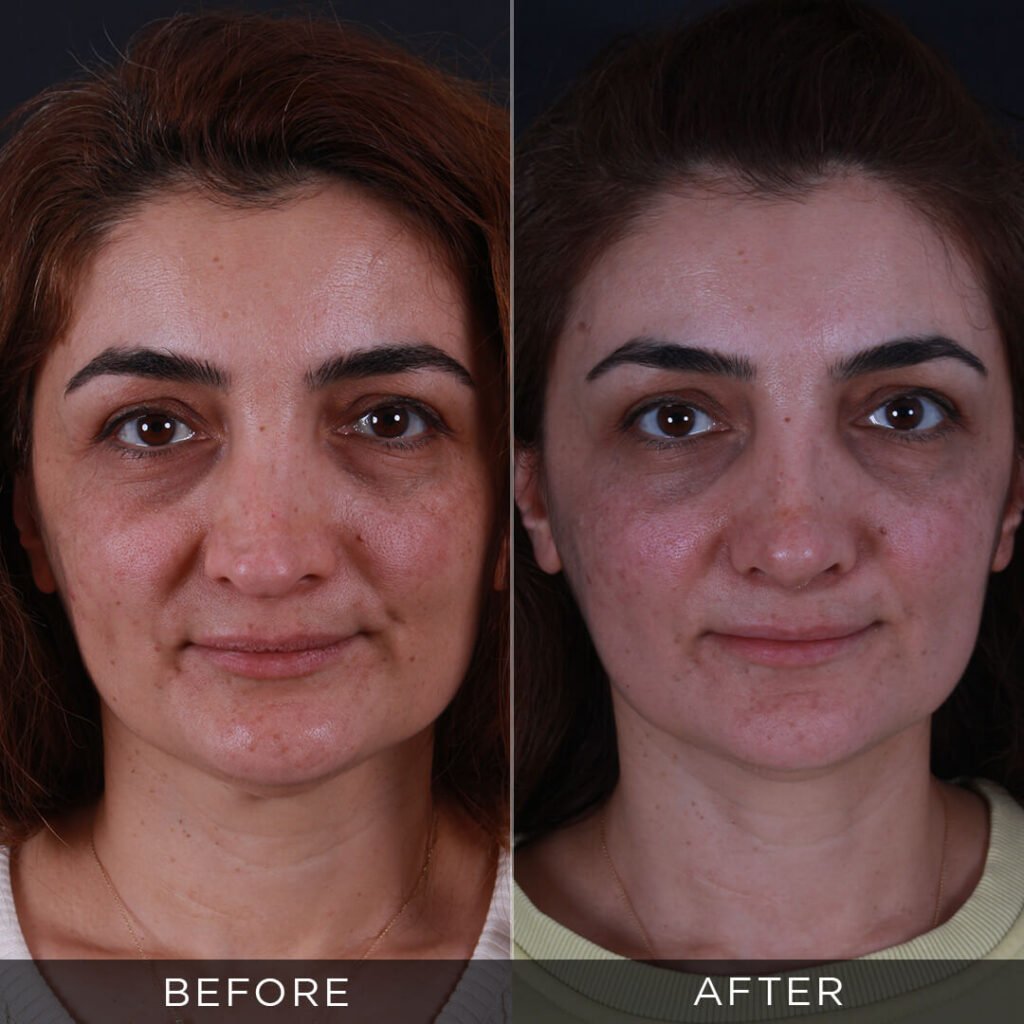 Revision Rhinoplasty in Turkey, Istanbul | Dr. Hasan Duygulu